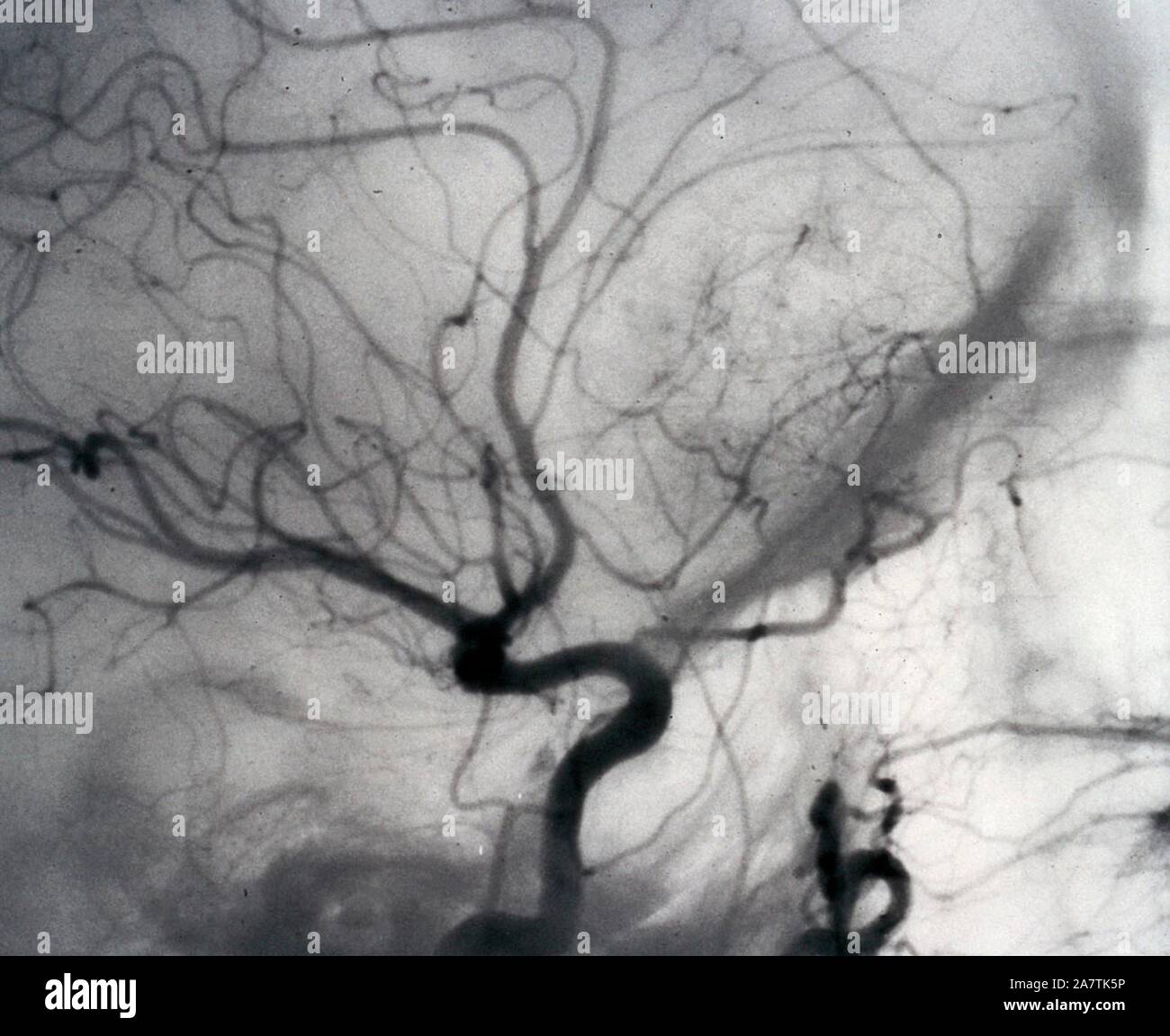 Brain Angiogram High Resolution Stock Photography and Images - Alamy