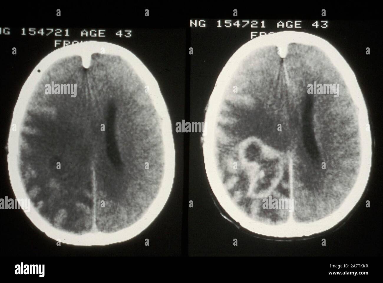 Glioma cerebrum hi-res stock photography and images - Alamy