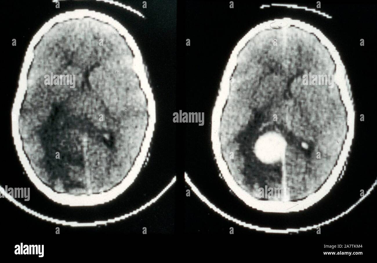 Meningioma hi-res stock photography and images - Alamy