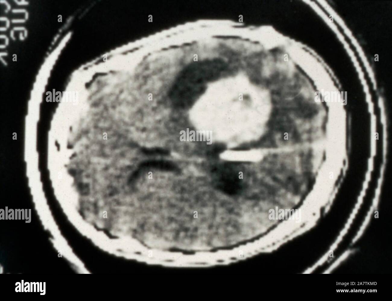 Choroid plexus papilloma hi-res stock photography and images - Alamy