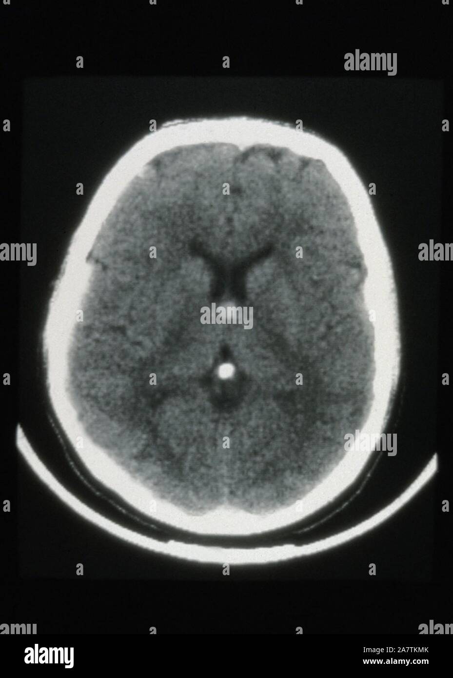 Colloid cyst hi-res stock photography and images - Alamy