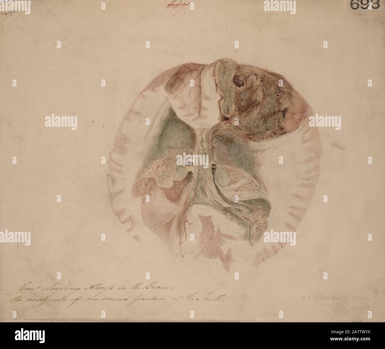 Brain abscess hi-res stock photography and images - Alamy