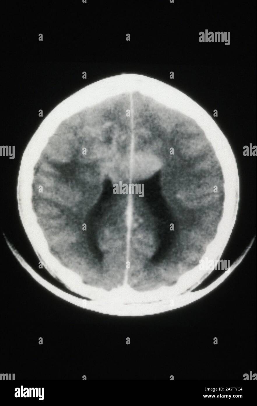 Corpus callosum hi-res stock photography and images - Alamy