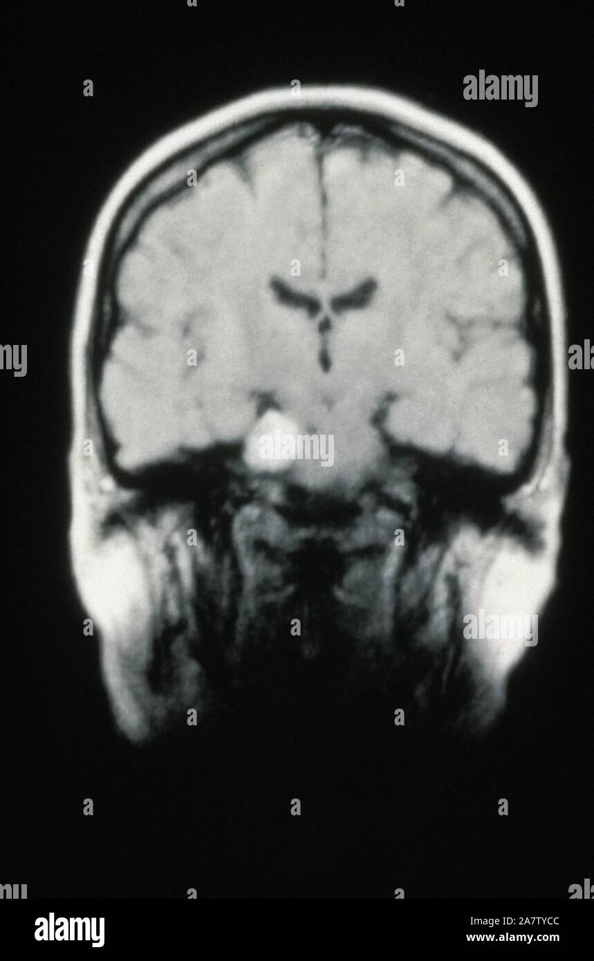 Meningioma High Resolution Stock Photography and Images - Alamy