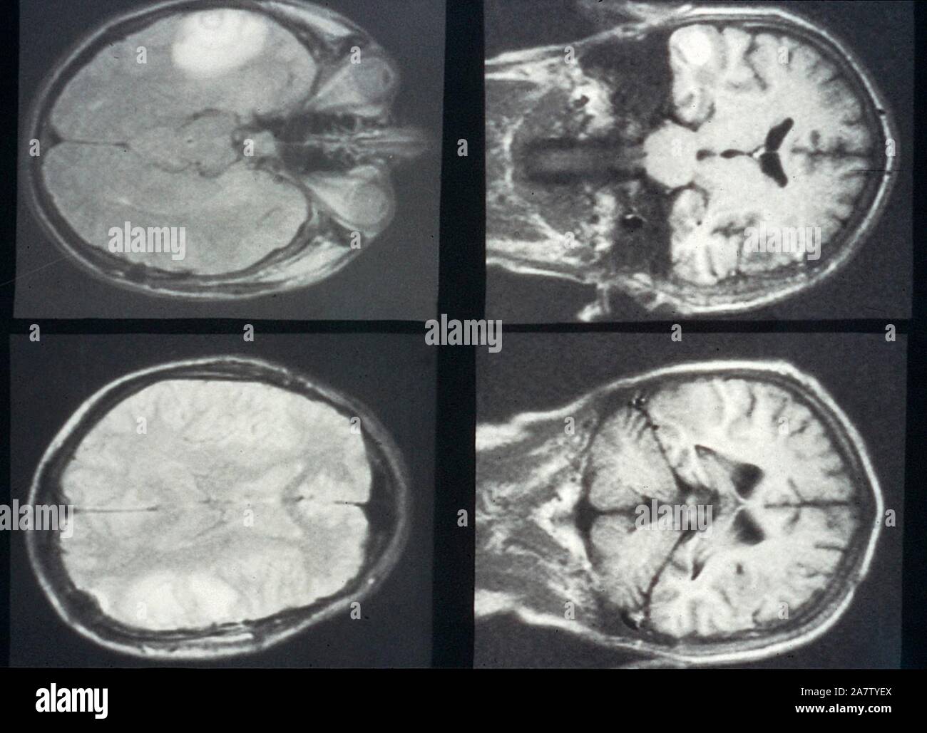 Brain metastases mri hi-res stock photography and images - Alamy