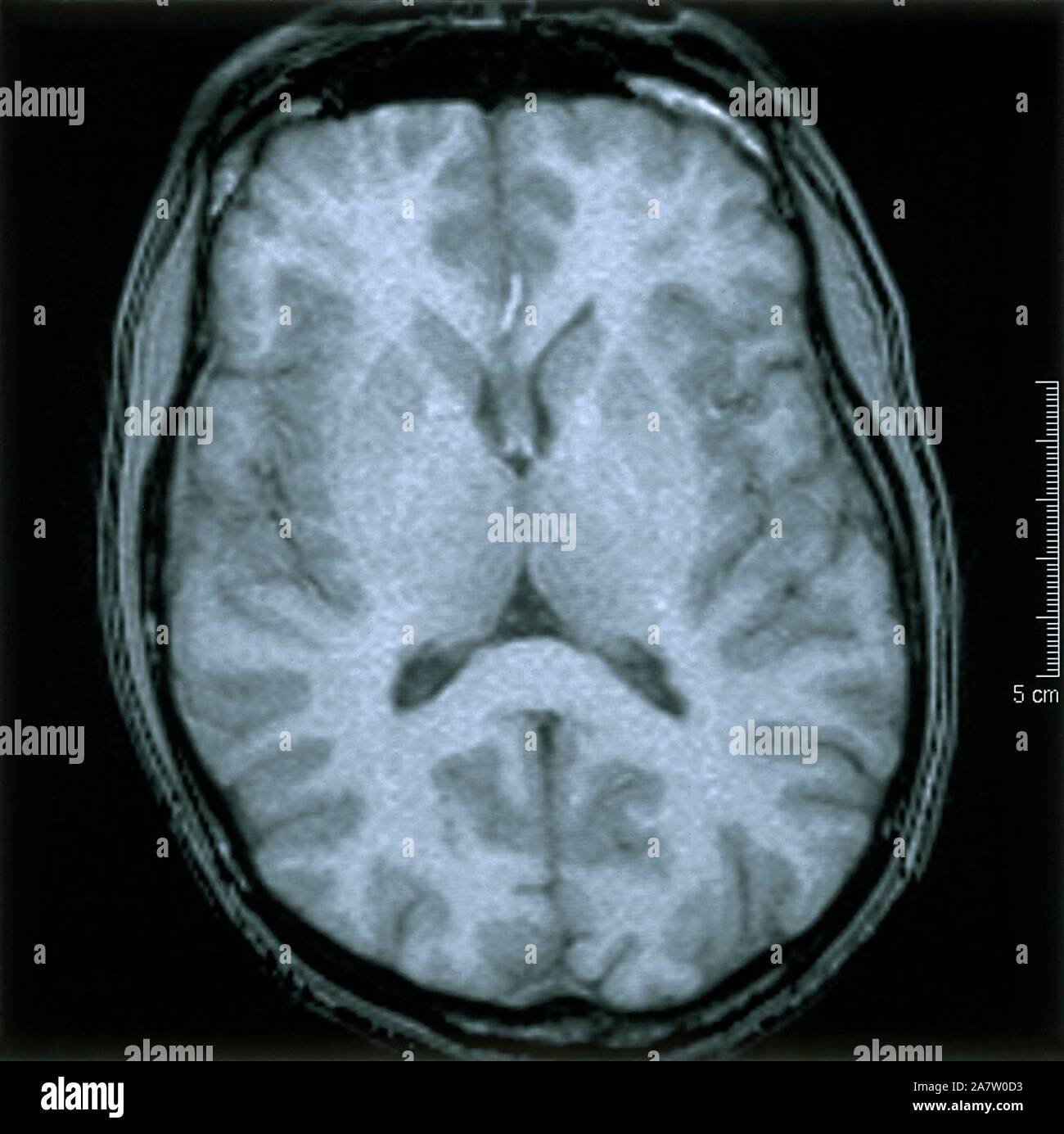 Human brain axial mri scan hi-res stock photography and images - Alamy
