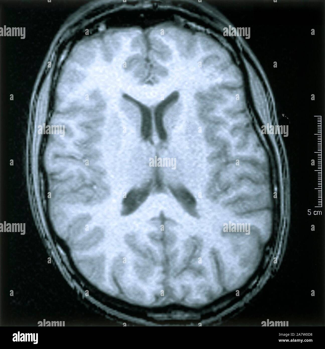 Human brain axial mri scan hi-res stock photography and images - Alamy