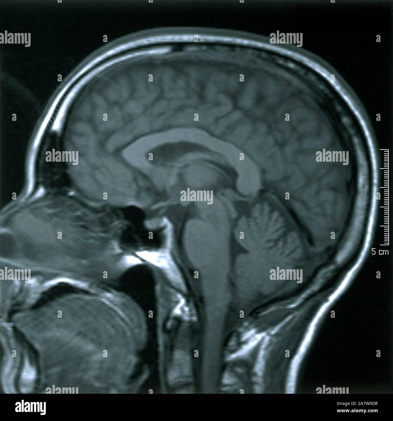 Mri normal brain of human hi-res stock photography and images - Alamy