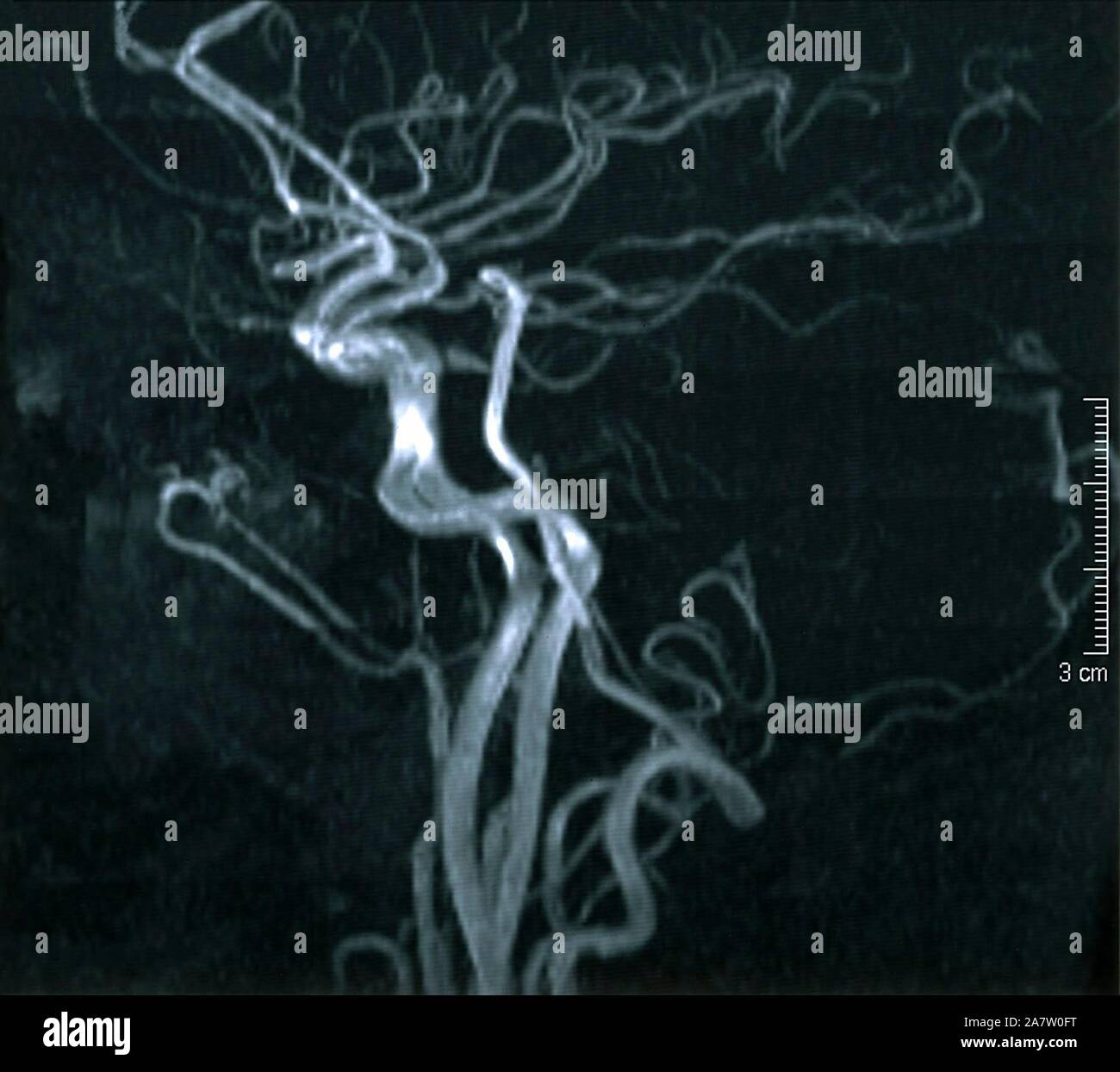 Angiogram head hi-res stock photography and images - Alamy