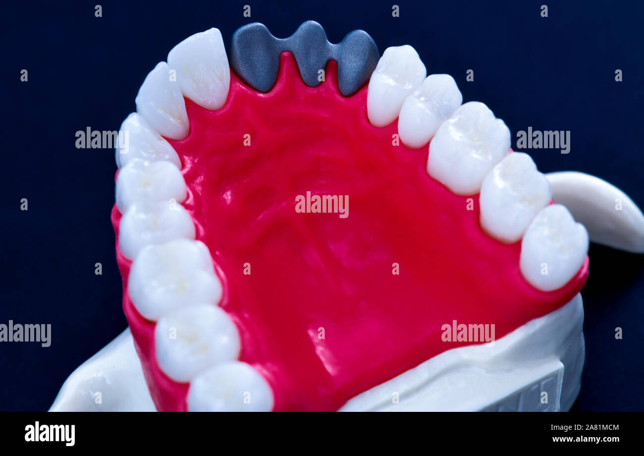 Teeth implant and crown installation process isolated on a blue ...