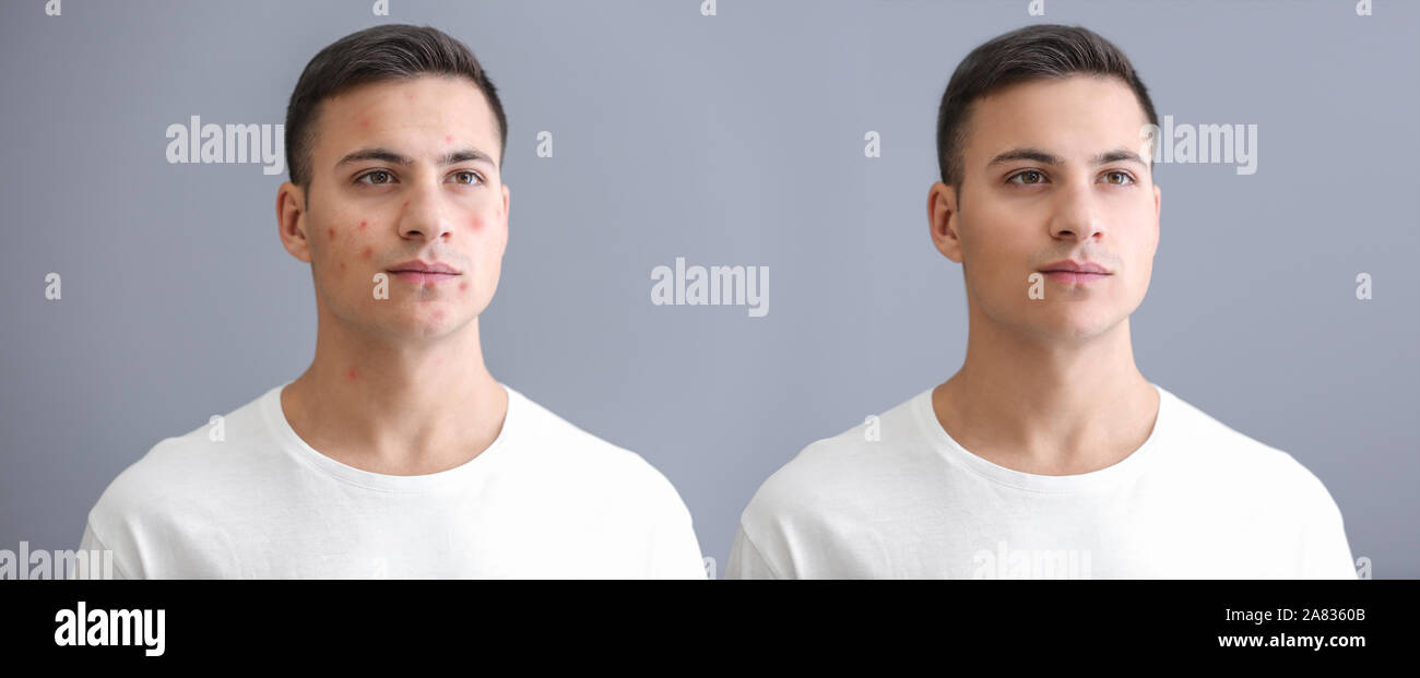 Young man with and without acne problem on grey background Stock Photo ...