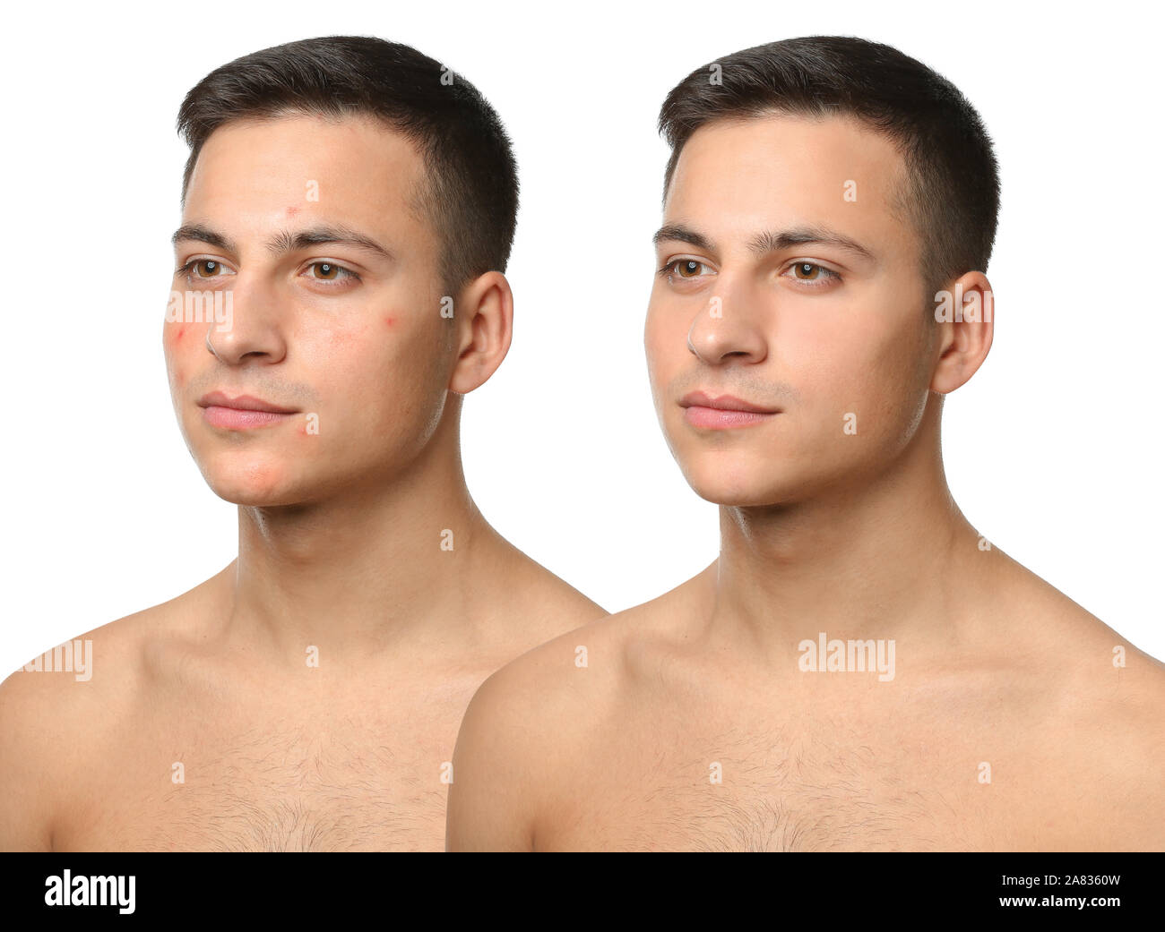 Young man with and without acne problem on white background Stock Photo ...
