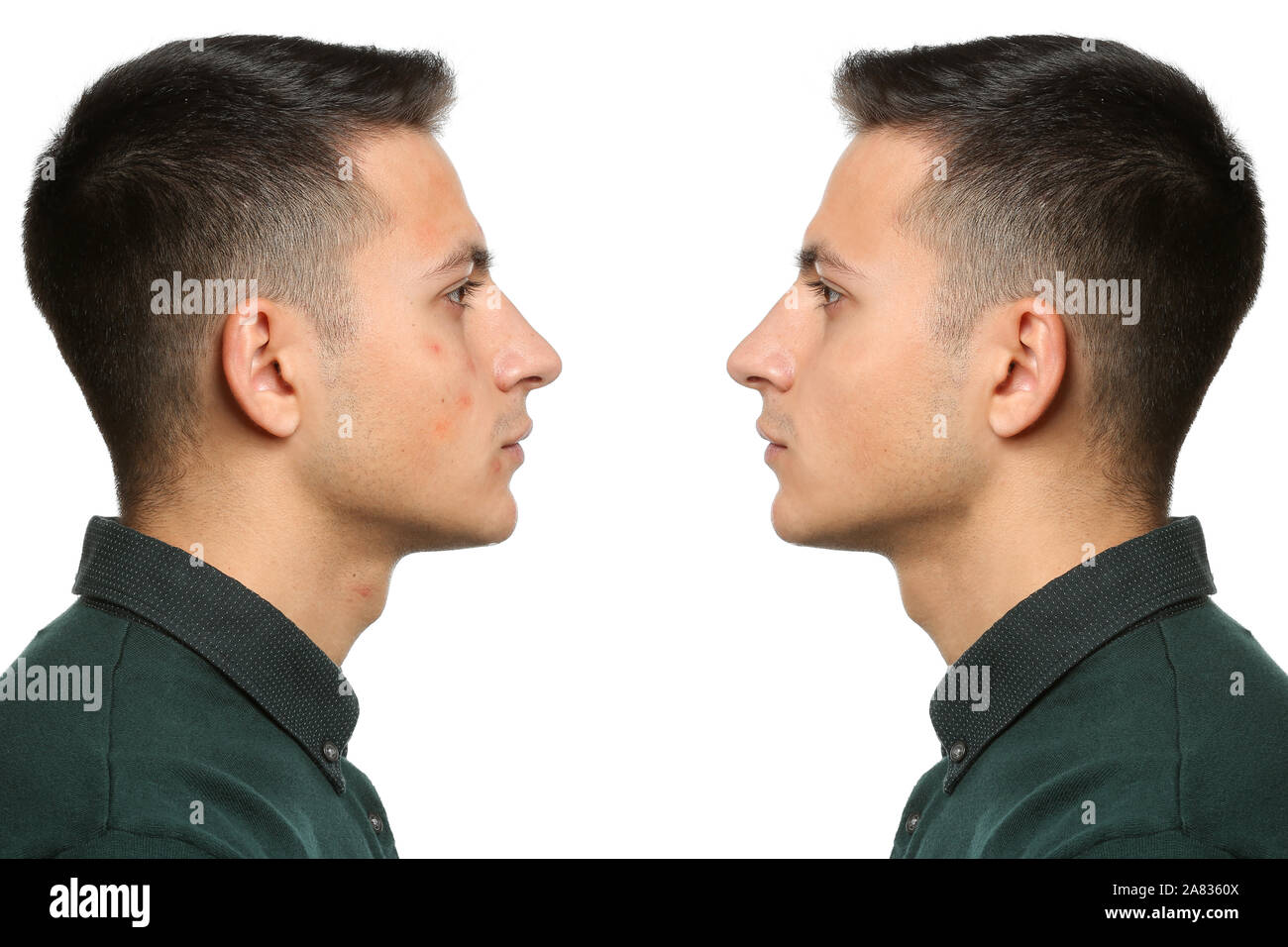 Young man with and without acne problem on white background Stock Photo ...