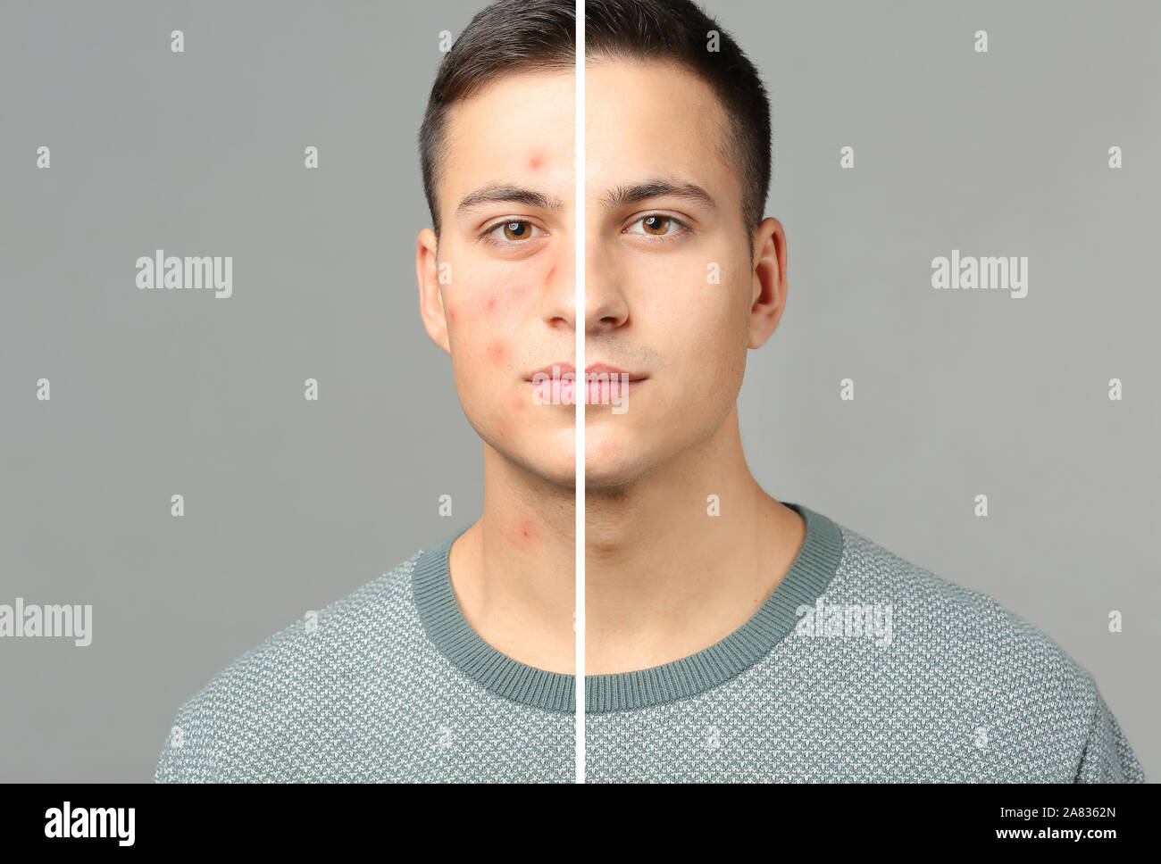 Young man with and without acne problem on grey background Stock Photo ...