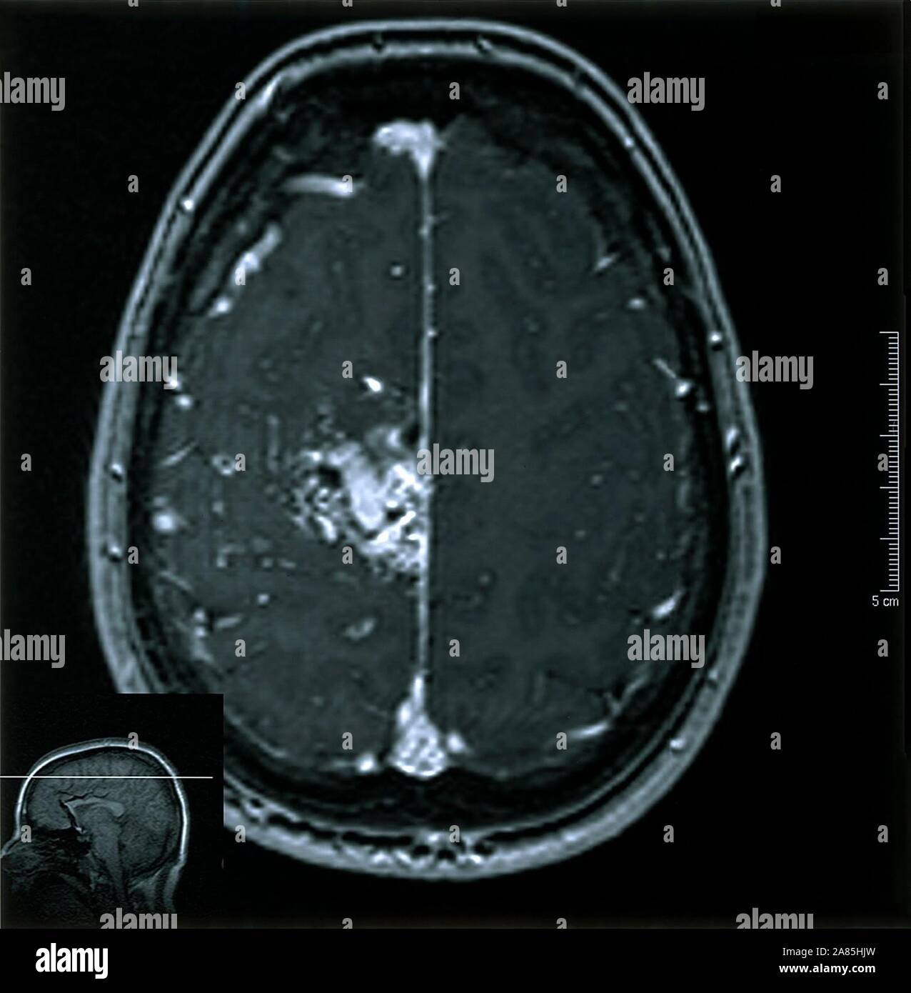 Brain malfunction hi-res stock photography and images - Alamy