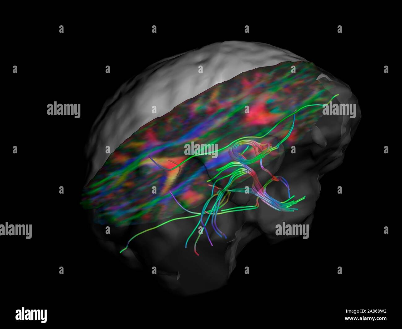 White Matter Fibres Of The Human Brain High Resolution Stock ...
