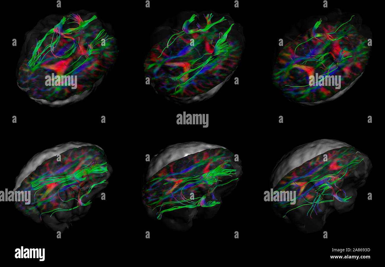 White matter fibres human brain hi-res stock photography and images - Alamy