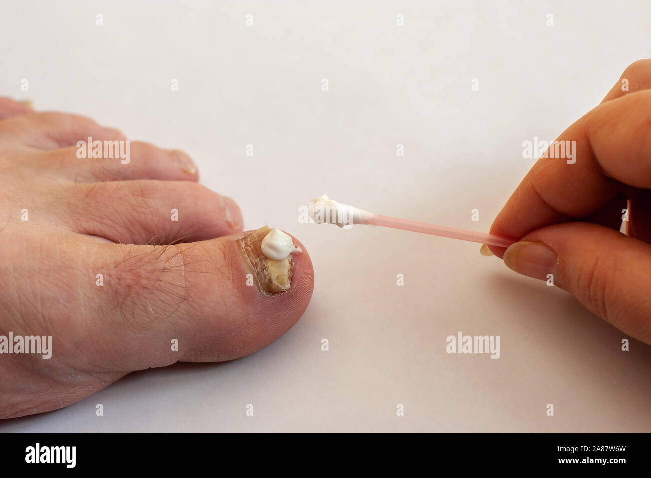 Toe Nail Damage High Resolution Stock Photography and Images - Alamy