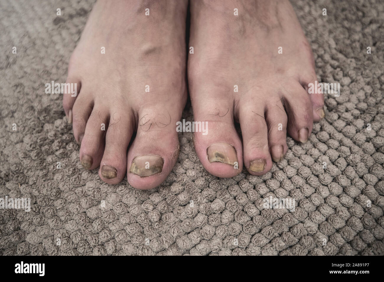 Onychomycosis with fungal nail infection two feet Stock Photo - Alamy