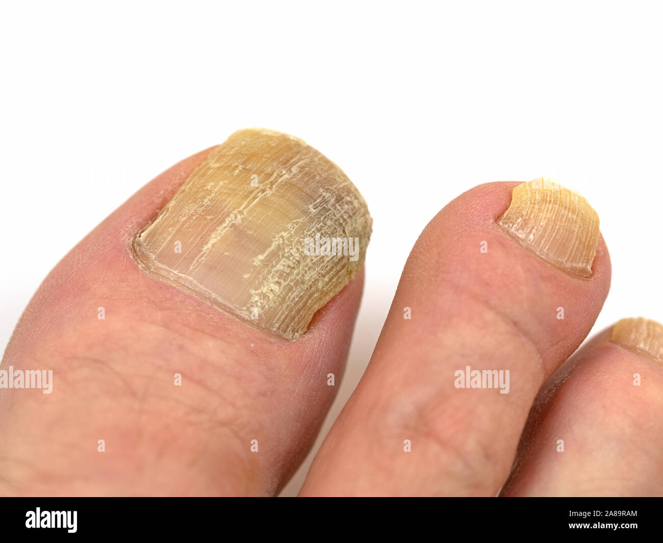 Nail fungus, onychomycosis, foot toes in front of white background ...