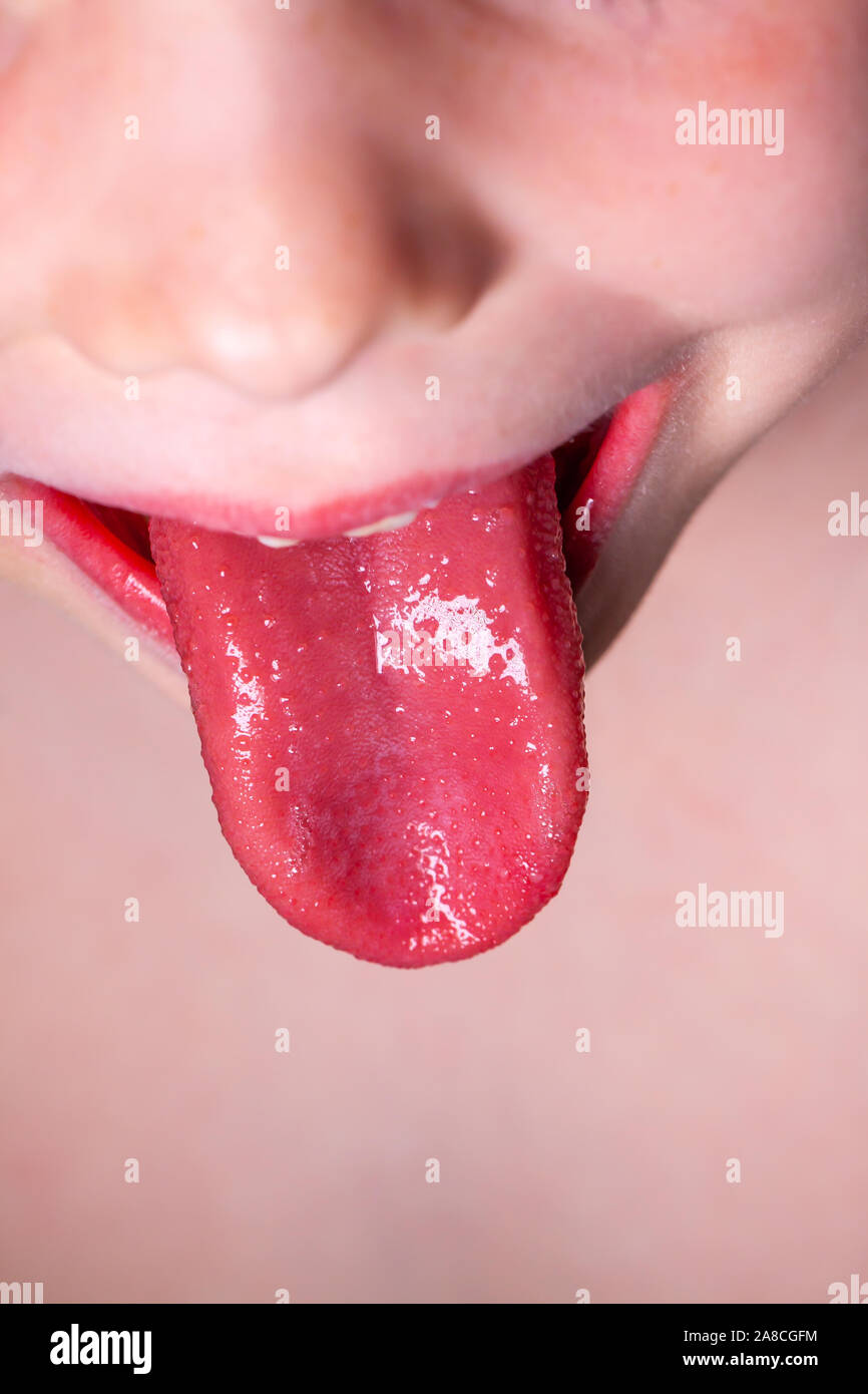 Tongue of a child with scarlet fever - strawberry tongue Stock Photo - Alamy