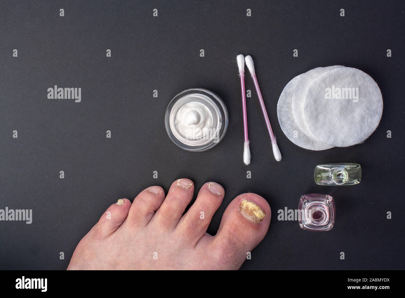 Flat lay. Fungus on the toenail. Cream in a jar, cotton pads and cotton ...
