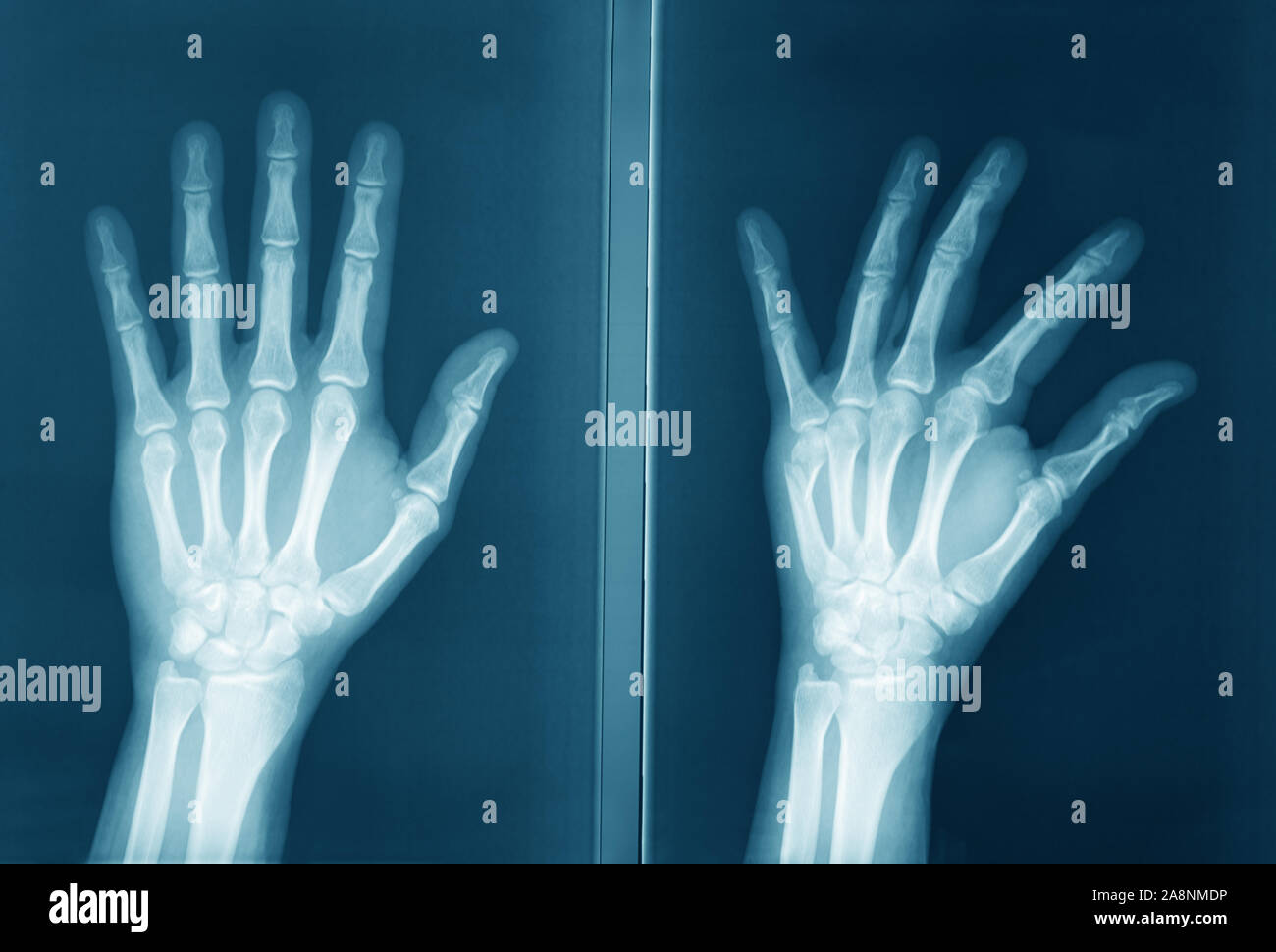 an original radiography of human hand Stock Photo - Alamy