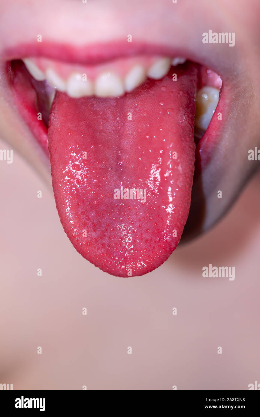 Scarlet fever tongue hi-res stock photography and images - Alamy