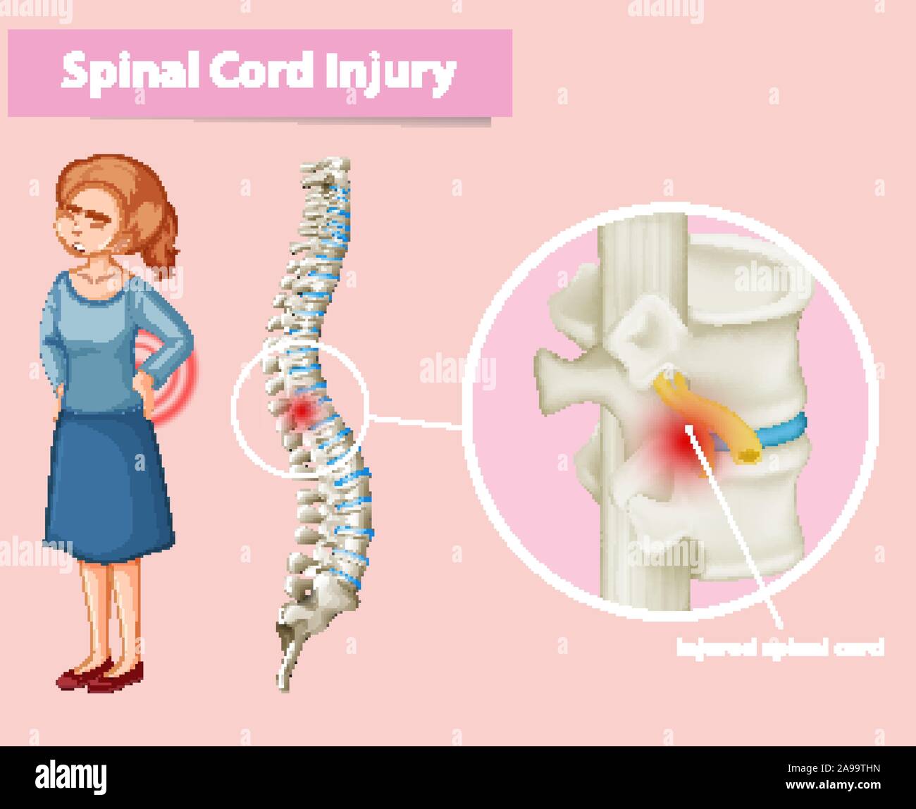 Animated Pictures Of The Spine Injuries