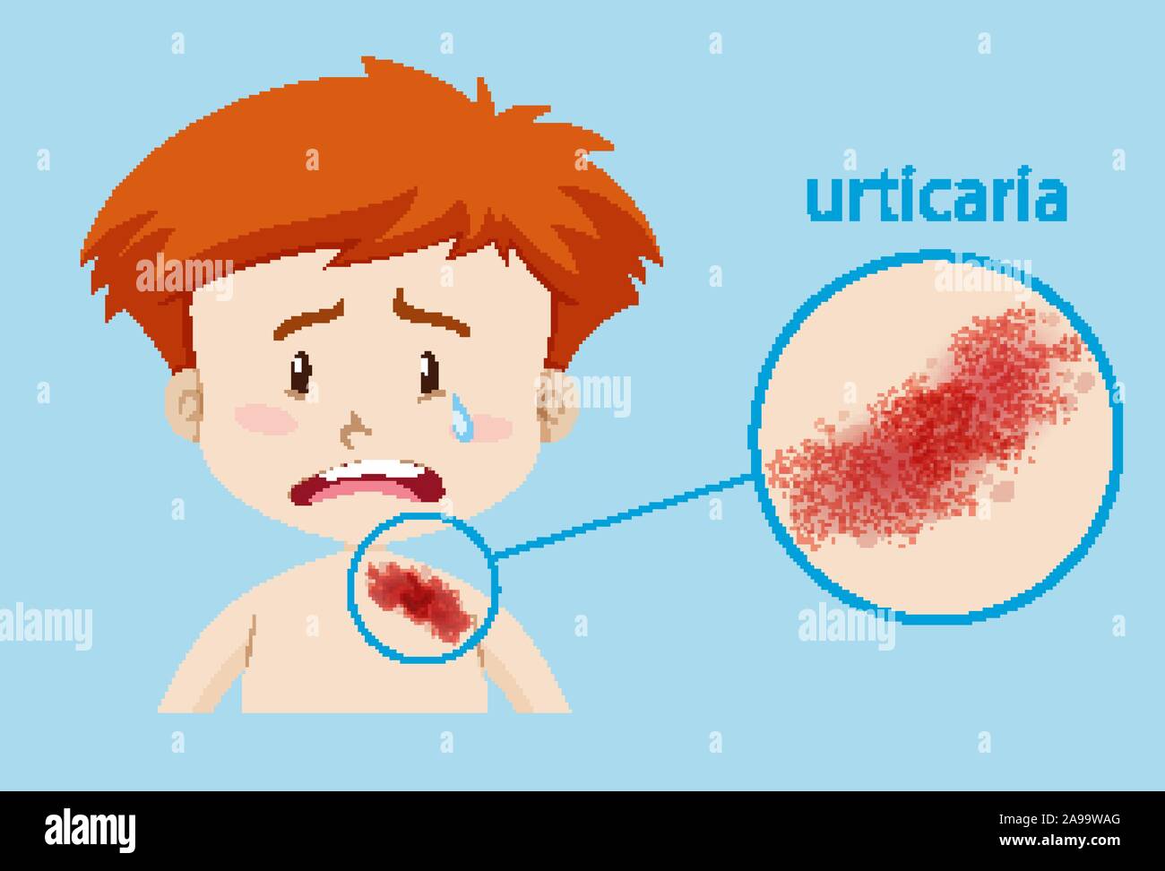 Diagram showing boy with urticaria illustration Stock Vector Image ...