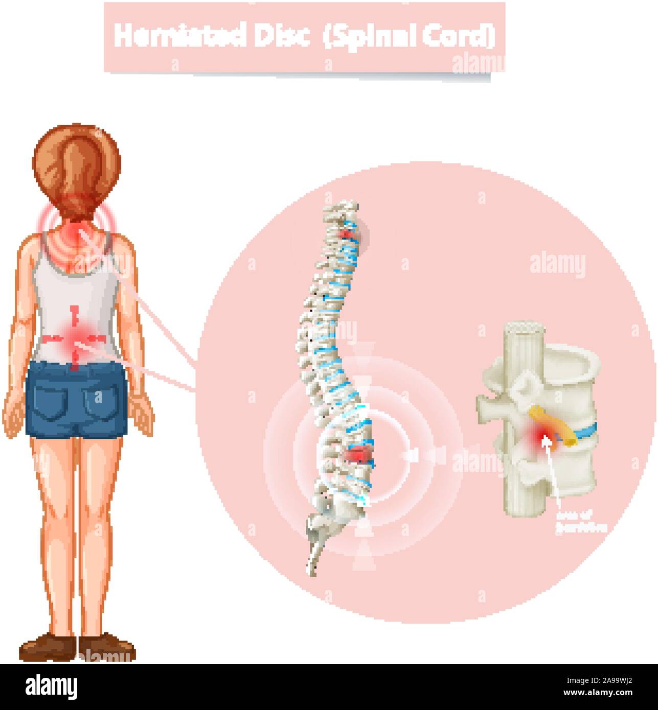 Diagram Of Herniated Disc Label Herniated Disc Diagram Diagr