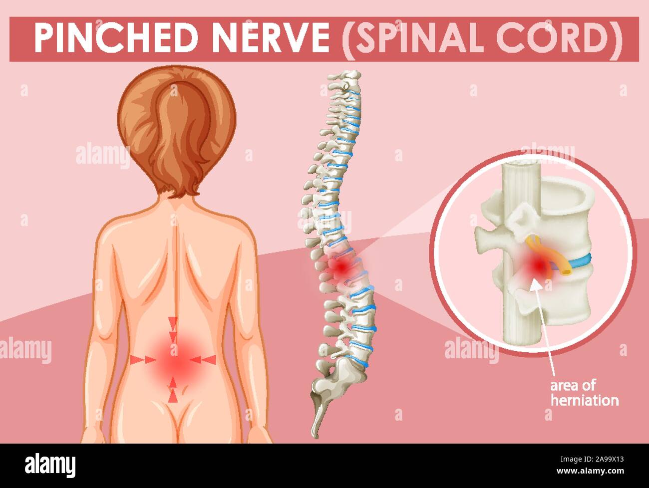 Diagram showing pinched nerve in human illustration Stock Vector Image ... Diagram showing pinched nerve in human illustration Stock Vector Image ...