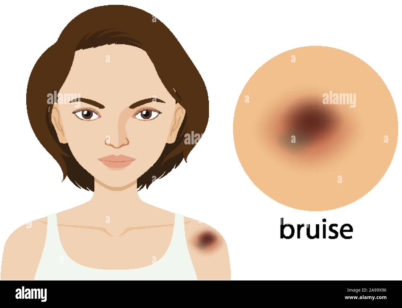 Woman with bruise on skin illustration Stock Vector Image & Art - Alamy