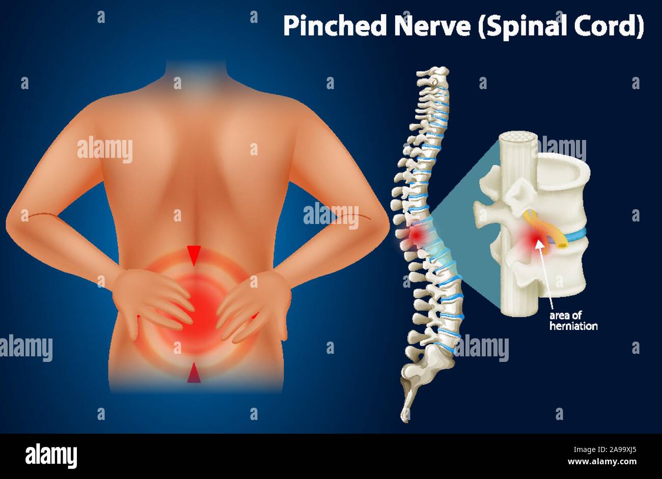 Diagram showing pinched nerve illustration Stock Vector Image & Art - Alamy Diagram showing pinched nerve illustration Stock Vector Image & Art - Alamy