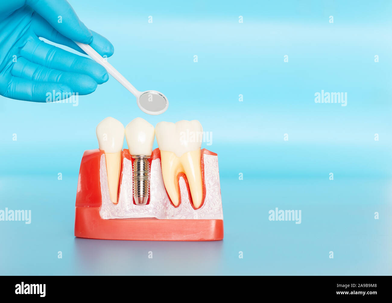 Plastic samples of dental implants compare with natural teeth for ...