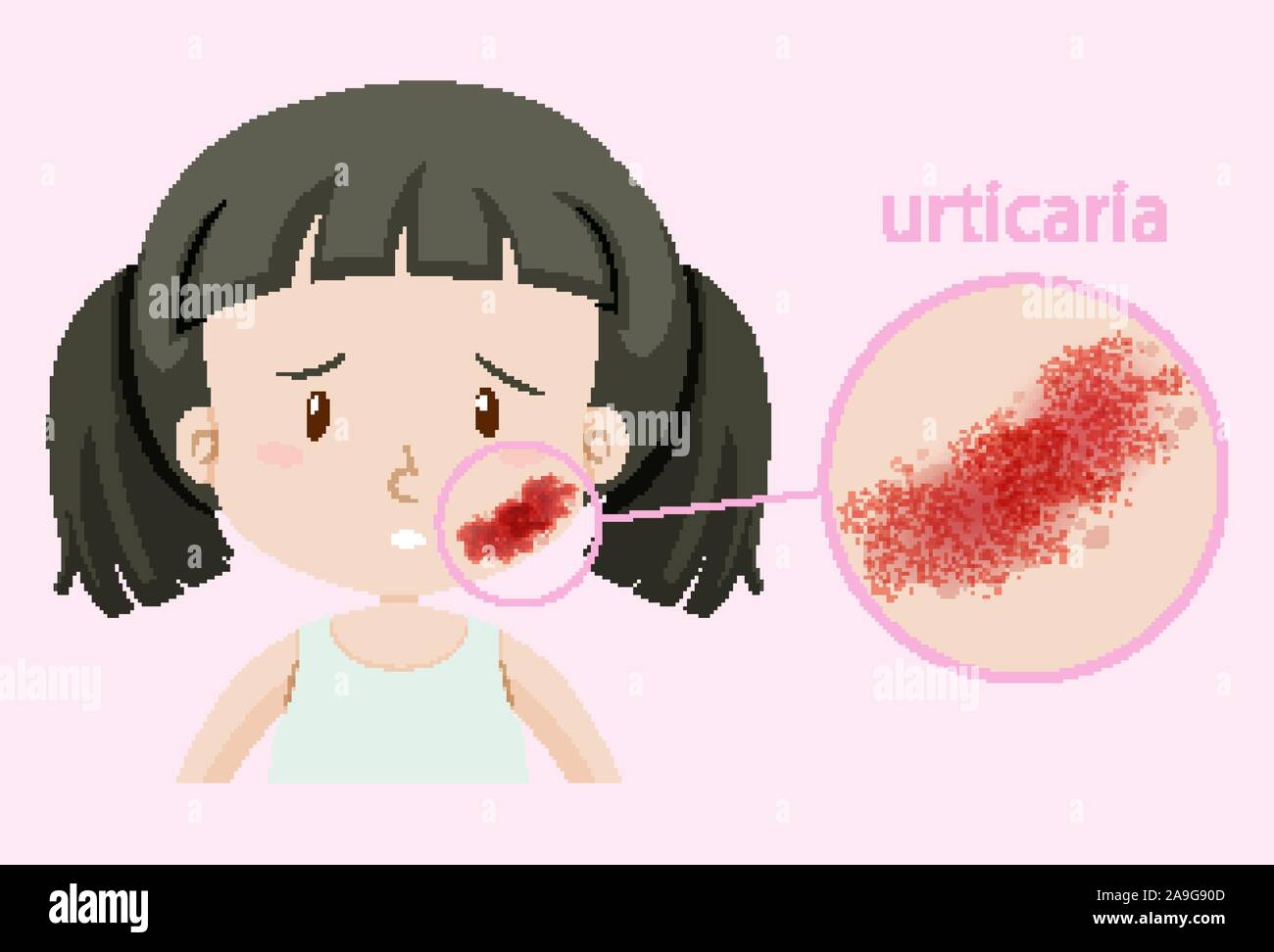 Girl with urticaria on her face illustration Stock Vector Image & Art ...