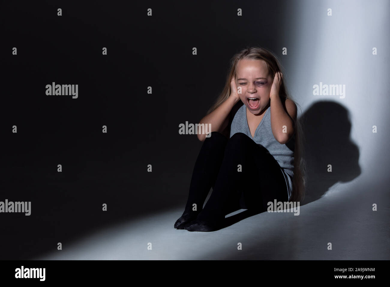 Sad and frightened little girl with bloodshot, bruised eyes crying ...