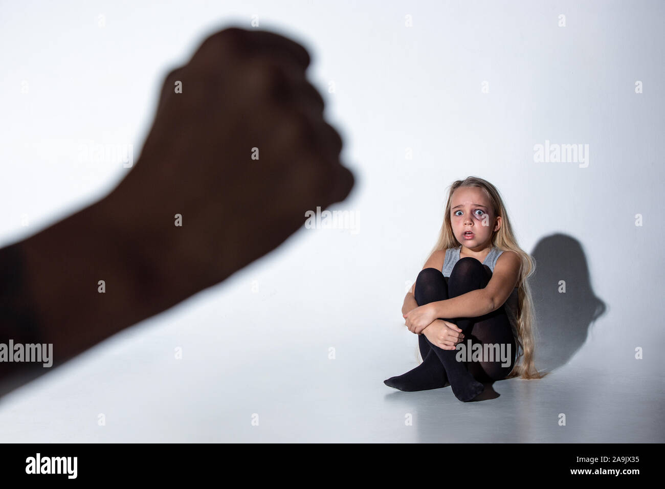 Sad and frightened little girl with bloodshot, bruised eyes crying ...