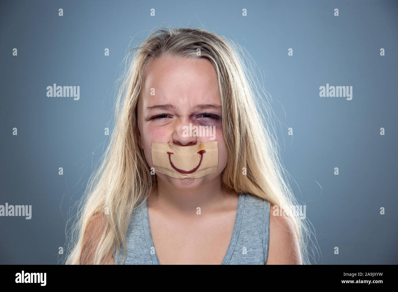 Sad and frightened little girl with bloodshot, bruised eyes and false ...