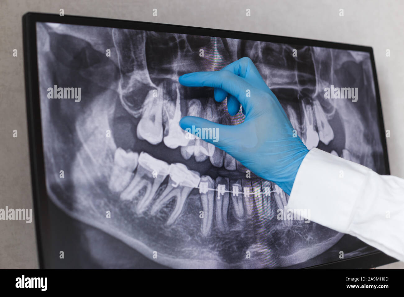 Doctor points to filled root canal in dental x-ray Stock Photo - Alamy