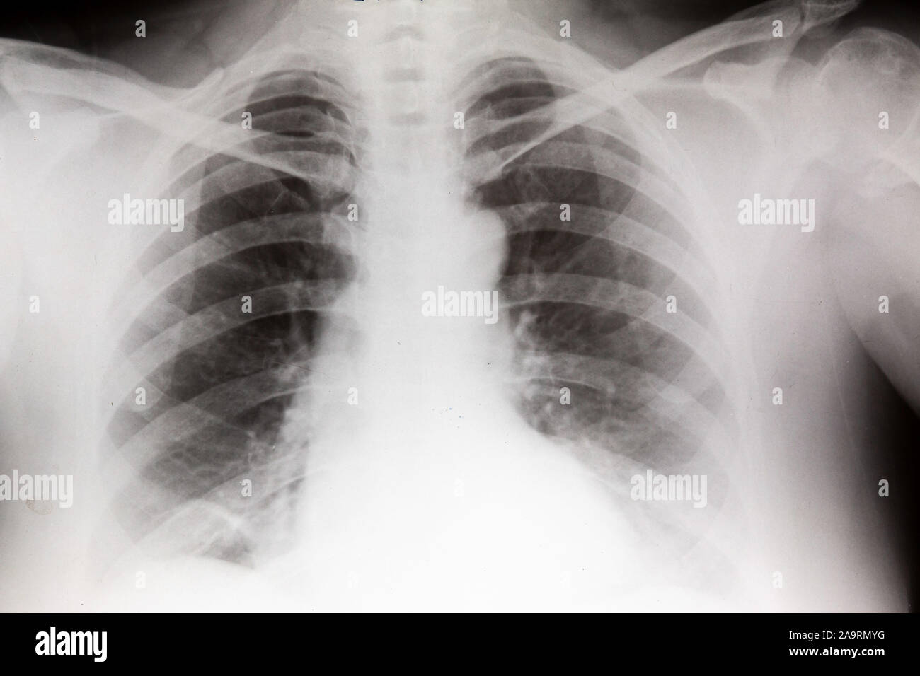 X-ray of a human chest showing the ribs and collar bones Stock Photo ...