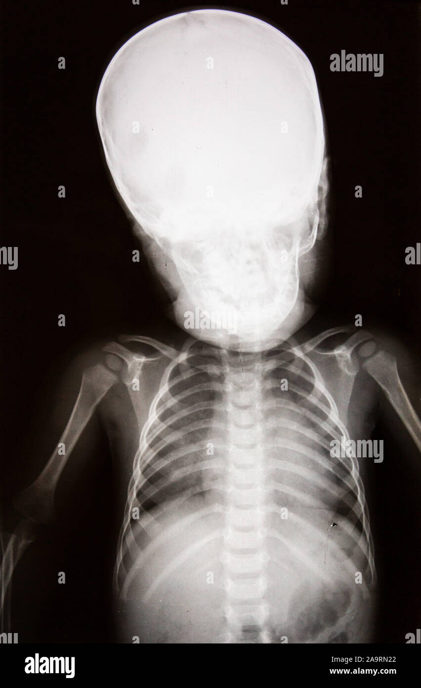 Xray Upper Body Normal Chest X Ray • LITFL Medical Blog • Labelled