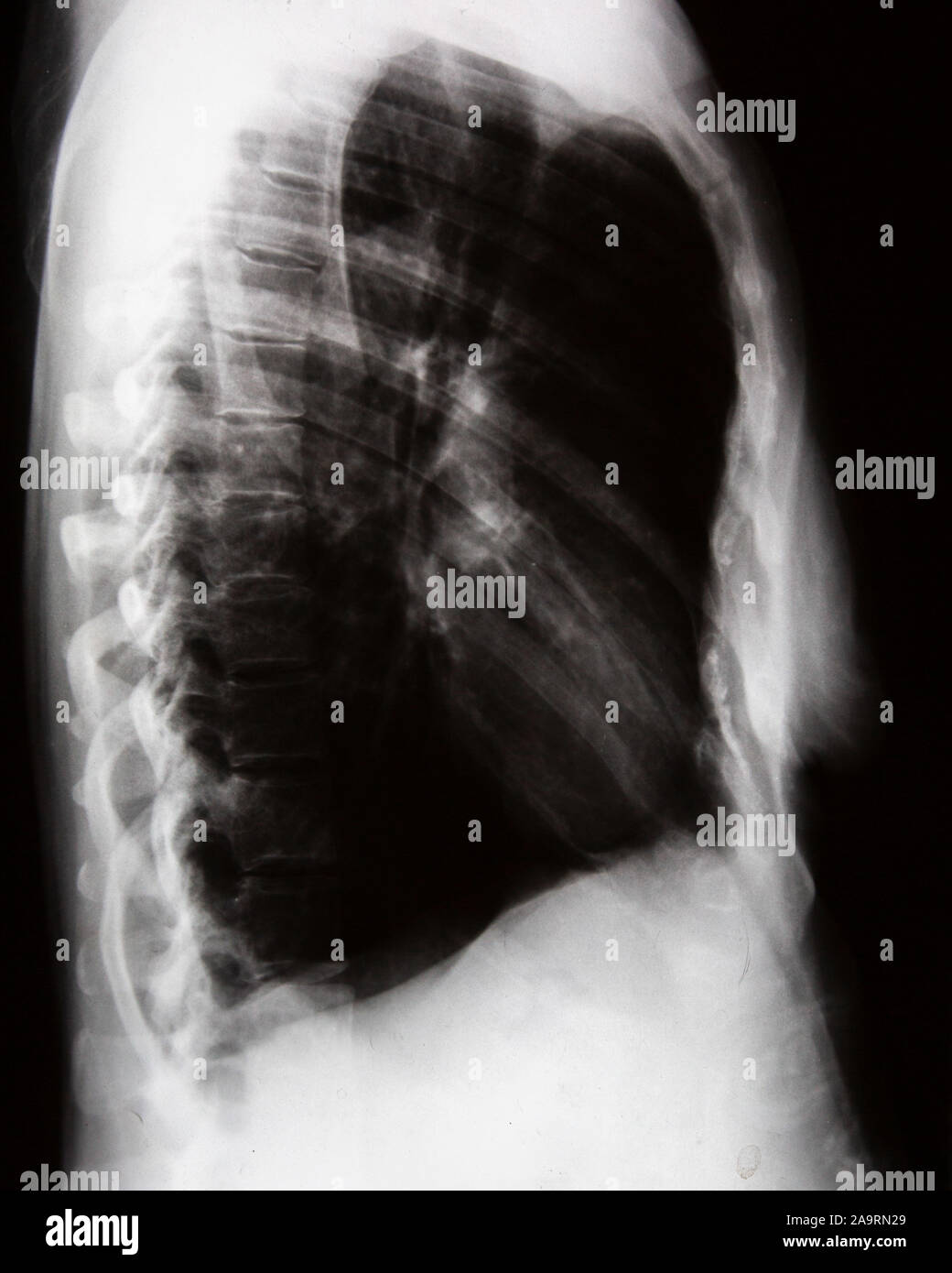 Side on xray of the upper human body Stock Photo - Alamy