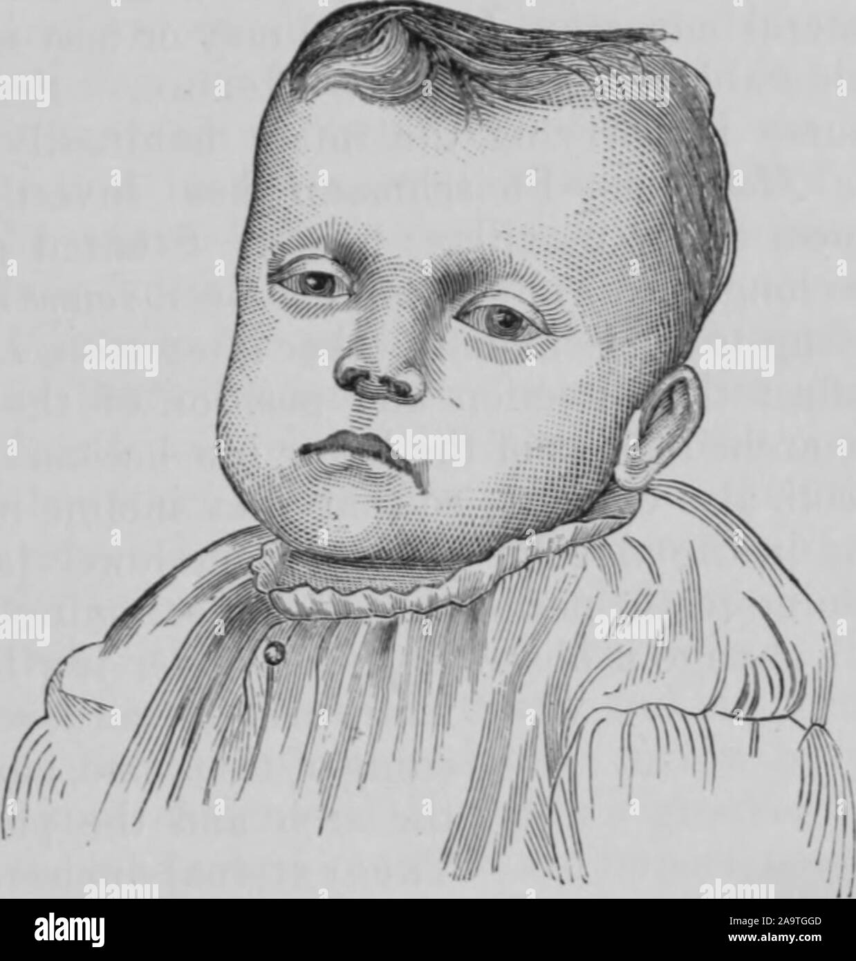 Rickets child hi-res stock photography and images - Alamy