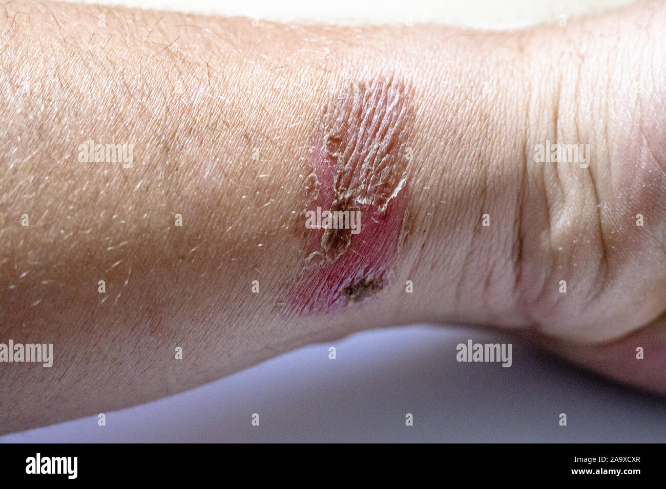 Badly healed burn on white young man's wrist Stock Photo - Alamy
