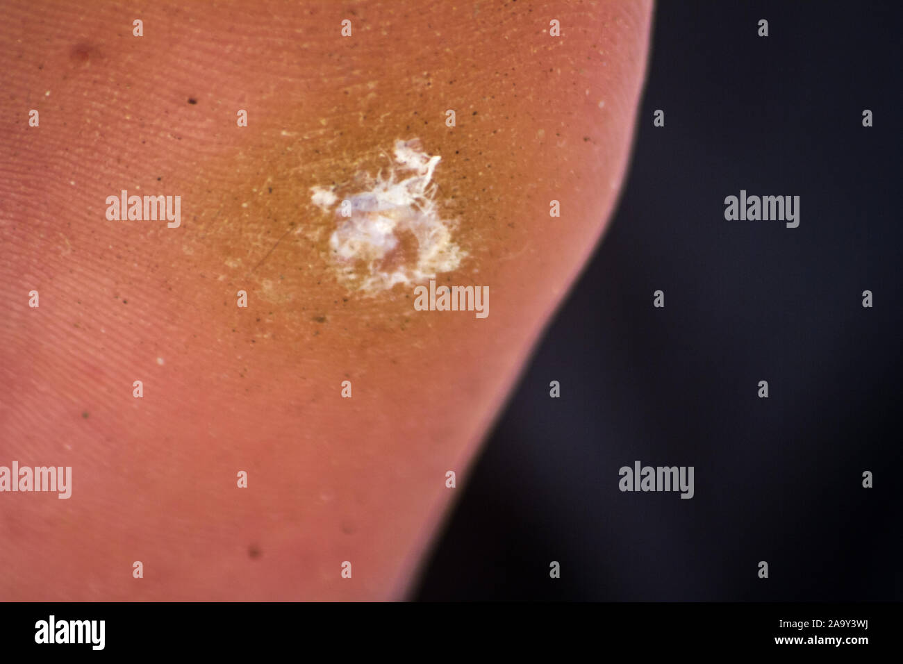 Wart on face hi-res stock photography and images - Alamy