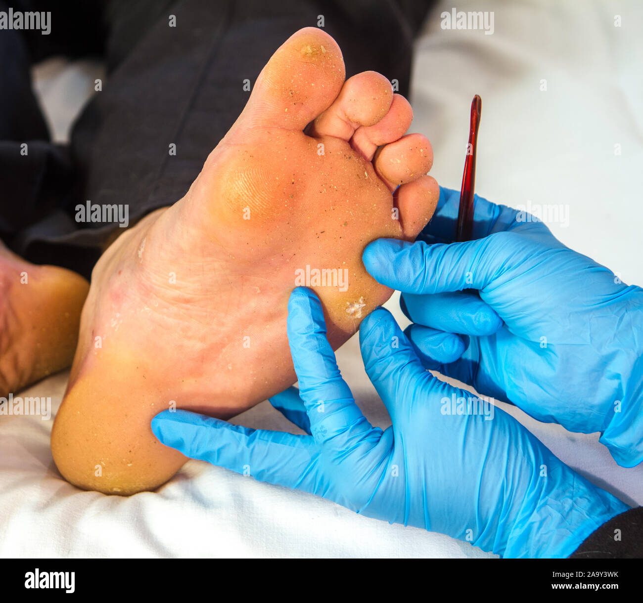 Verruca foot hi-res stock photography and images - Alamy
