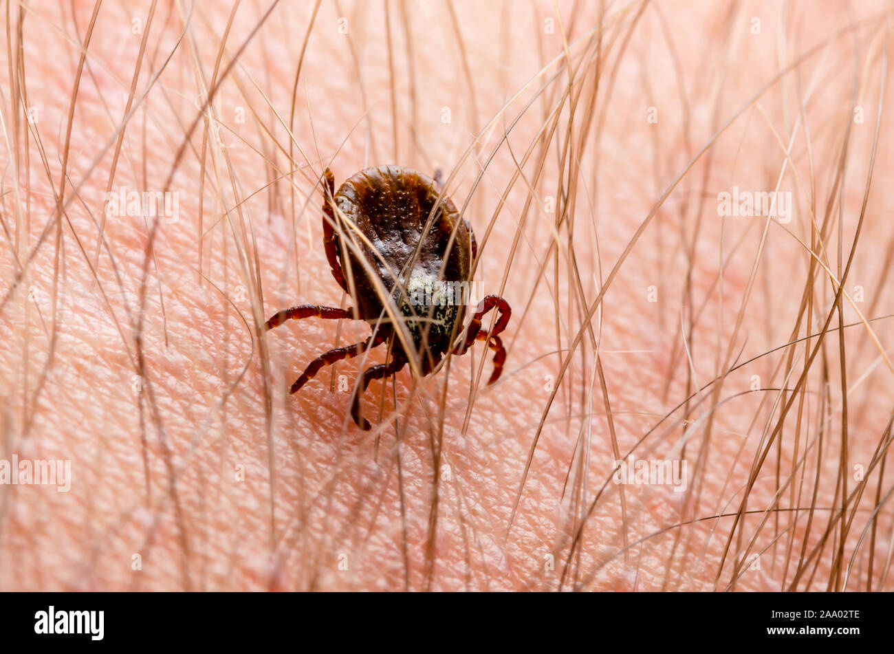 Lyme Disease Infected Tick Insect Crawling on Skin. Encephalitis Virus ...