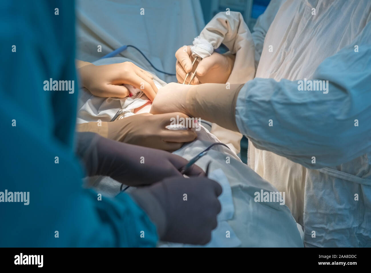 Cholecystectomy hi-res stock photography and images - Alamy