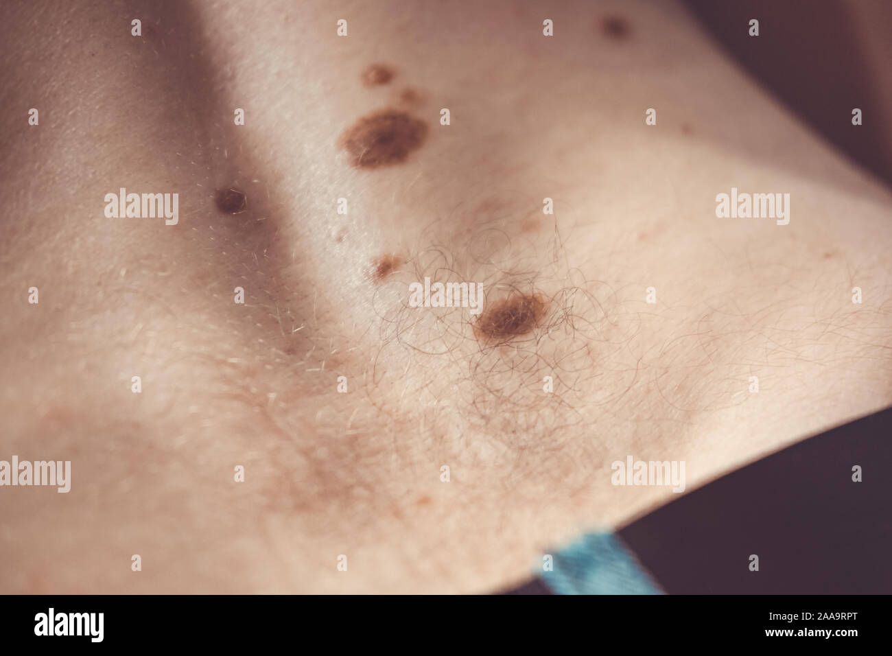 A melanocytic nevus also known as nevocytic or nevus-cell nevus and ...